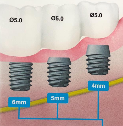 TSIII Ekstra korte fixturer - MaxFac Dental AS - OSSTEM